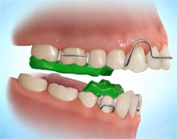 Myofunctional Appliances in Orthodontic Treatment Bangalore,India
